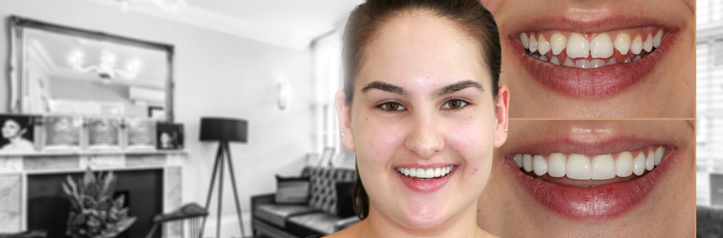 Tooth sculpting - Central London W1, UK - Harley Street Dental Studio